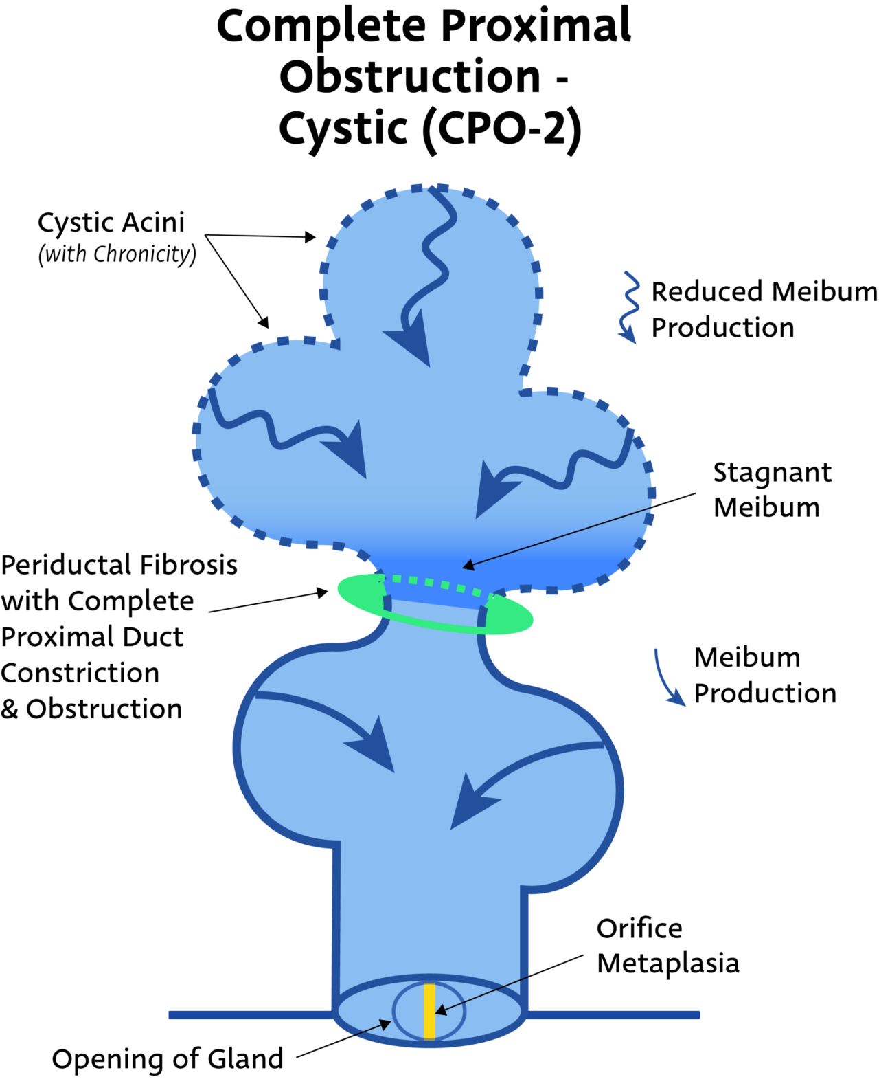 Meibomian Gland Dysfunction (MGD) Treatment Near Me in Tampa, FL | Eye ...